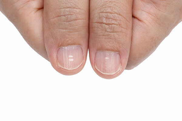 10 Right Ways to Trim Your Nails and Avoid Injuries