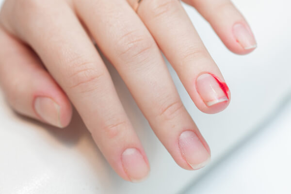 10 Right Ways to Trim Your Nails and Avoid Injuries