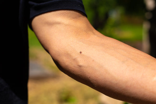 Threat of Scrub Typhus: Symptoms, Transmission, and Prevention