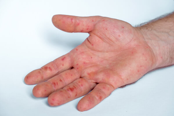 Suddenly Itchy and Peeling Palms: It Might be THIS Disease